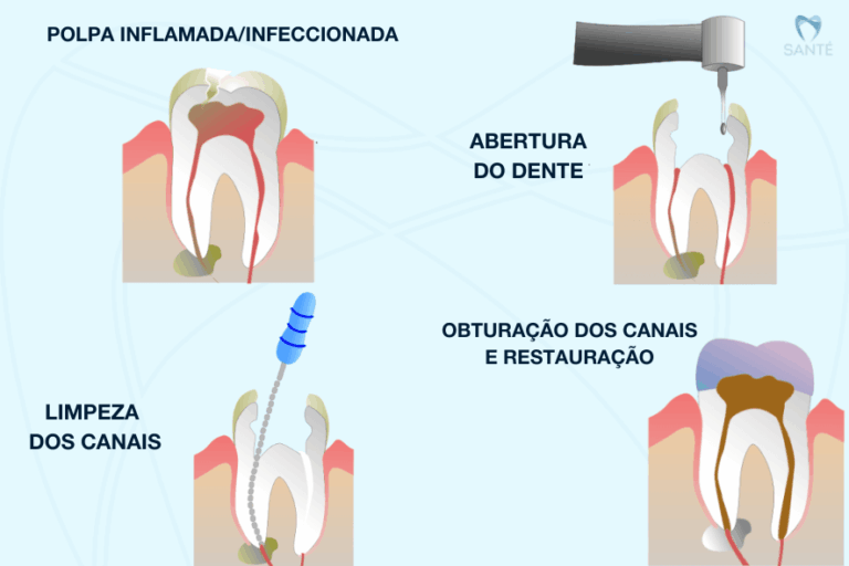 Canal em BH? - Como funciona o tratamento de canal